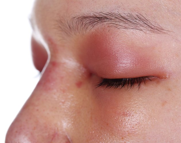 An Allergic Reaction That Causes The Eyes To Swell