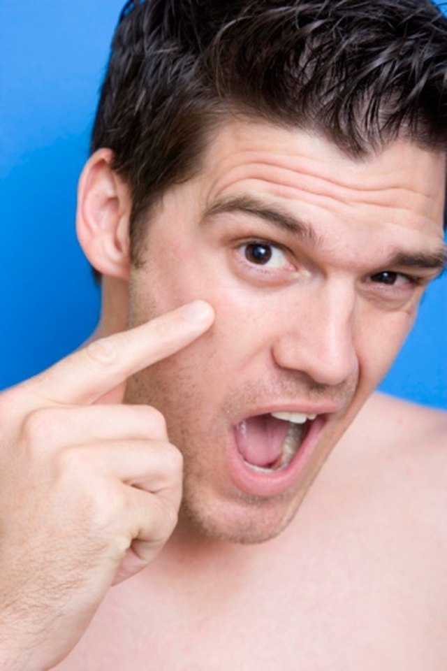 How To Remove Embedded Whiteheads Livestrong