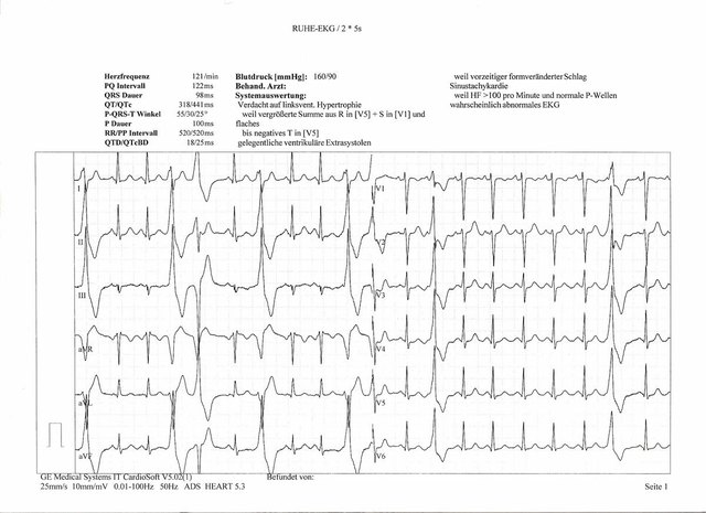 How To Read An Abnormal Ekg